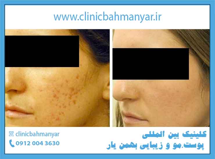 بهترین راهکارهای از بین بردن جای جوش و درمان آکنه کلینیک تخصصی پوست و